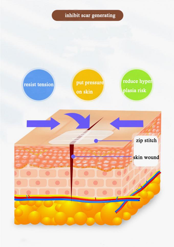 Non Invasive Zip Stitch Suture Wound Closure Device Skin Closure Non ...