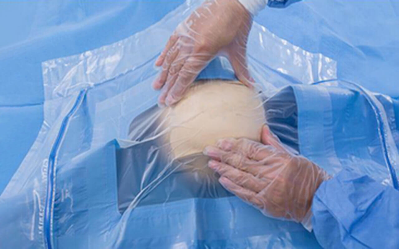 Medical Sterile Craniotomy Drape Surgical With Aperture 1pc / Pouch